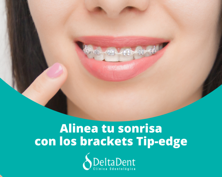 Brackets Tip-Edge: Ortodoncia avanzada para la Sonrisa Perfecta ...